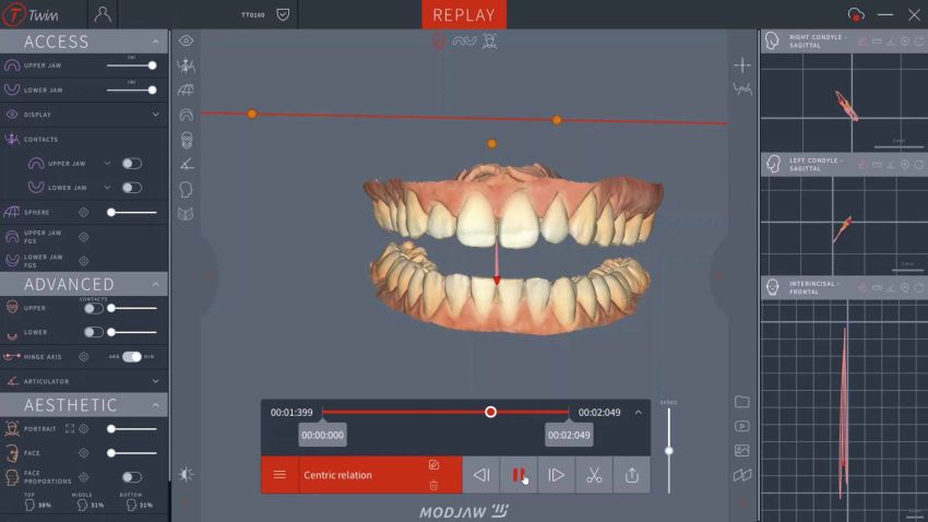 Modjaw™ - Access twim™